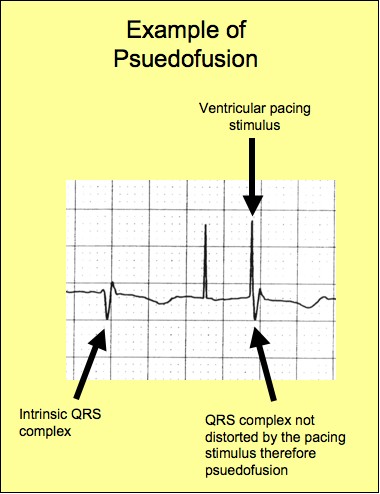 Cardiac Nurse: Teaching As I Learn: DDD pacing with psuedo fusion