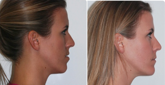 Jaw Surgery Fun!: 1 Year Post-Op