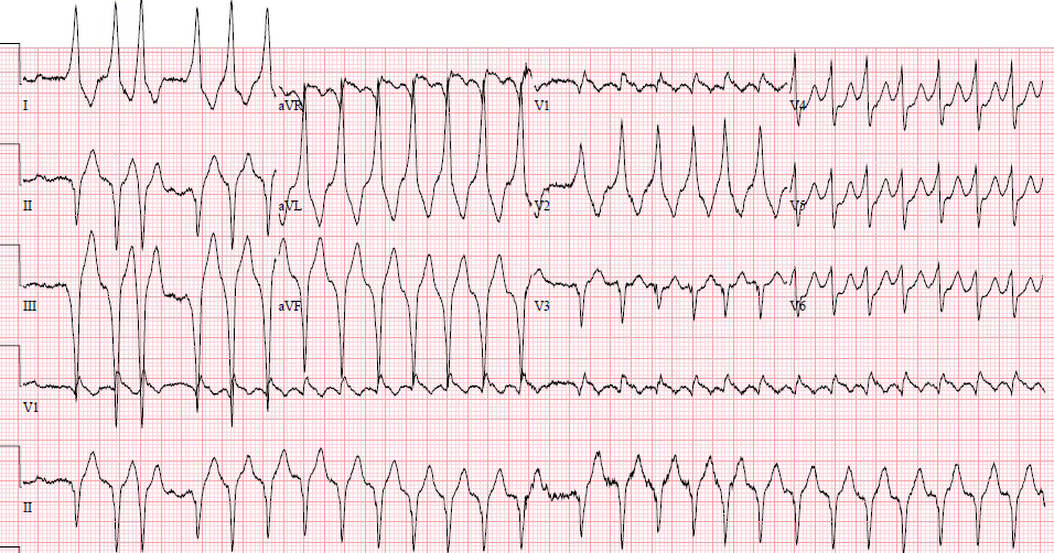 Dr. Smith's ECG Blog: Wide Complex Tachycardia: is the patient stable ... Dr. Smith's ECG Blog: Wide Complex Tachycardia: is the patient stable ...