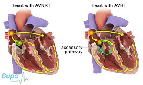 Hospitalist ~病院総合診療医~: PSVT: Paroxysmal Supraventricular Tachycardia 発作 ...