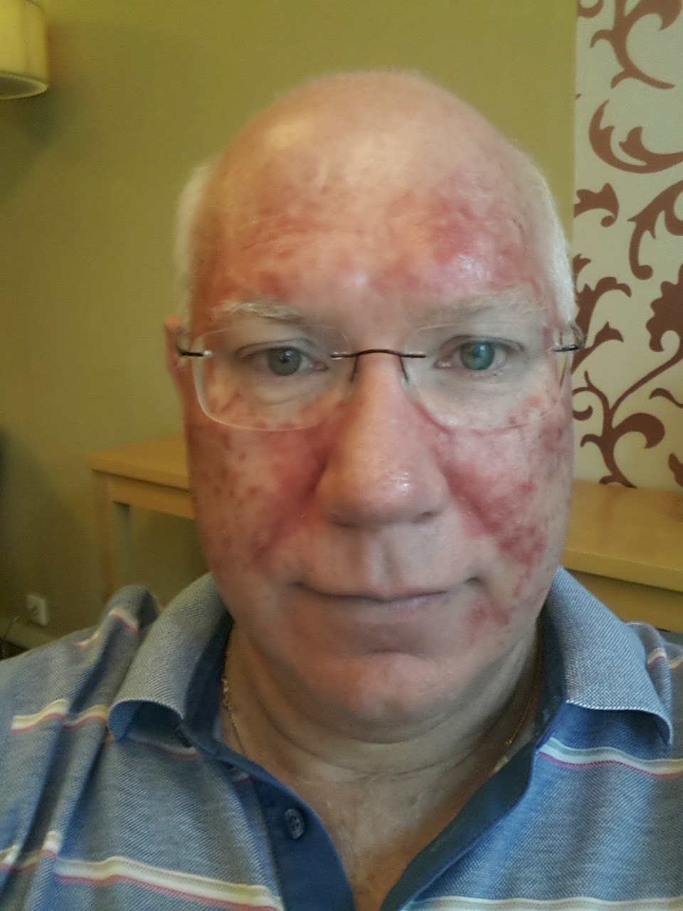 Resultaat gebruik Efudix: Algemeen