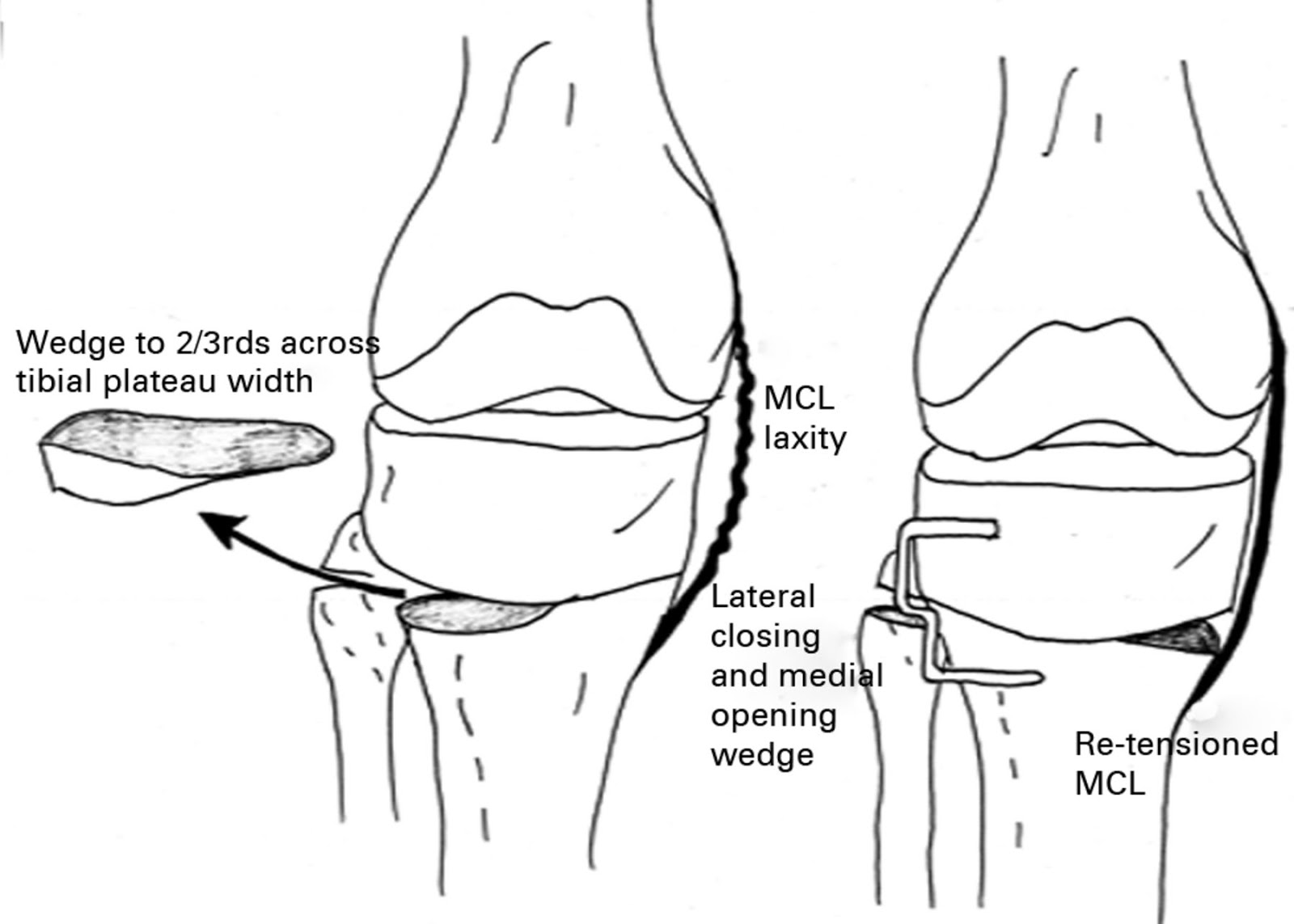 Cortex Medx (nanonotes): Supracondylar Humerus Fracture