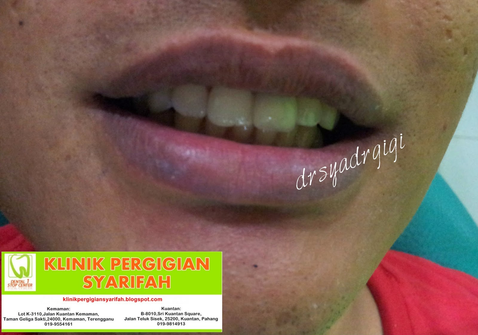 KLINIK PERGIGIAN SYARIFAH: GIGI DEPAN YANG BERMASALAH-GIGI TAK SAMA PANJANG