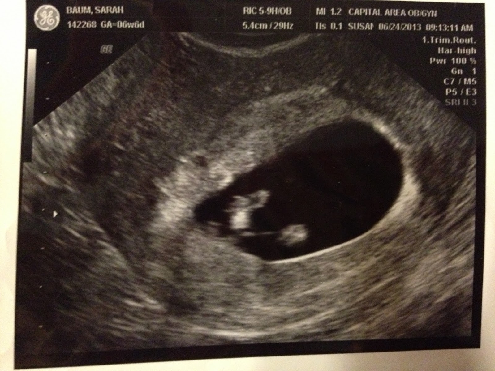 Ultrasound At 7 Weeks
