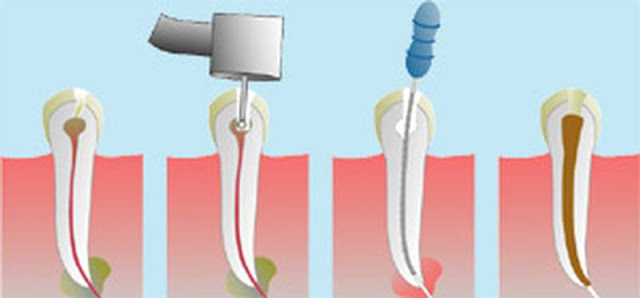 Mydentalsharing: Der Ablauf einer Wurzelkanalbehandlung