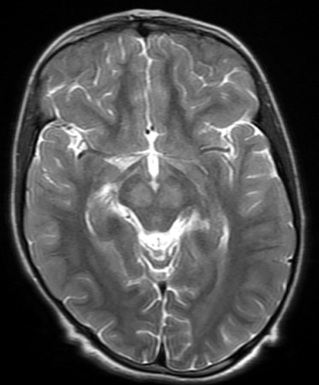 Face of the giant panda and her cub- Wilson's Disease - Sumer's ...