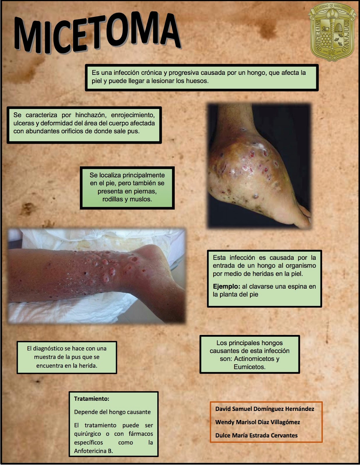 DIVULGACIÓN CIENTÍFICA UG: Micetoma