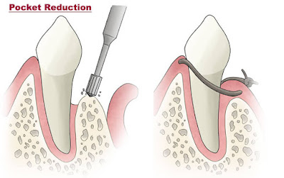 Dentist Best Dental Clinic in Vasundhara: What is Periodontal Surgery ...