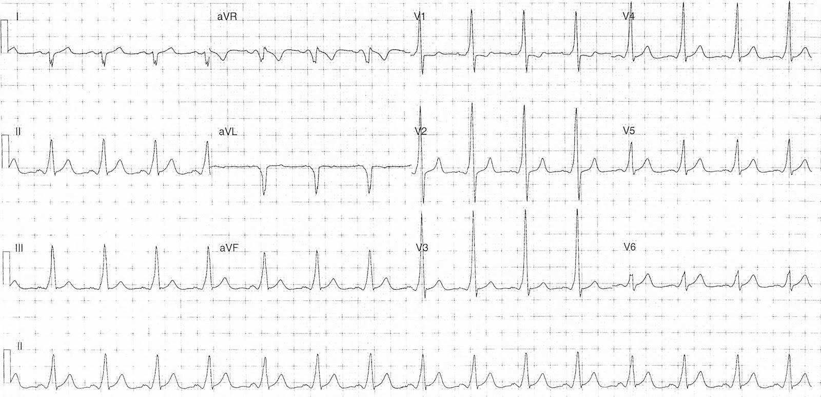 ECG of the Week: ECG of the Week - 4th April 2016 - Interpretation