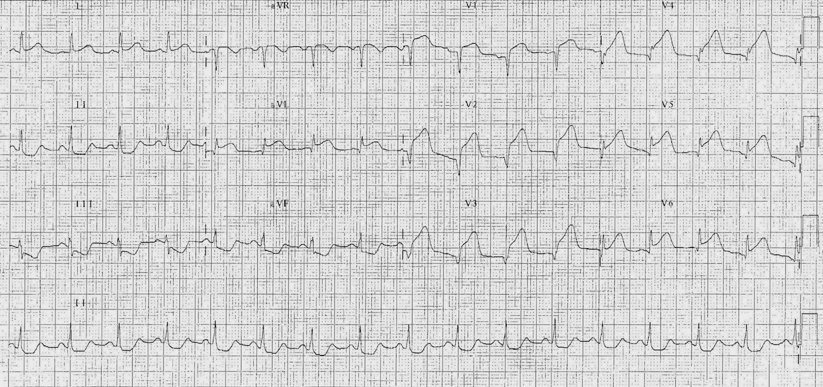 ECG of the Week: ECG of the Week - 2nd February 2015 - Interpretation