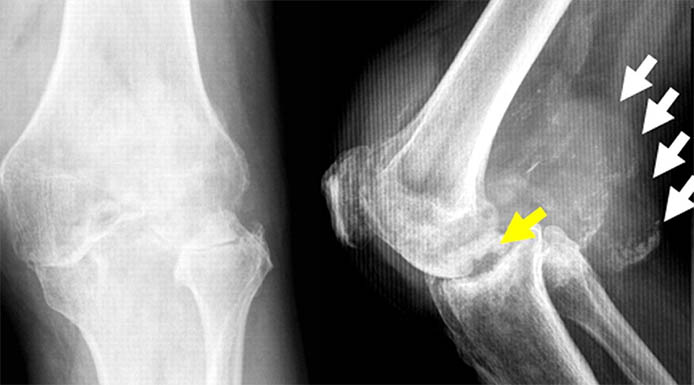 Tuberculous arthritis in clinical practise
