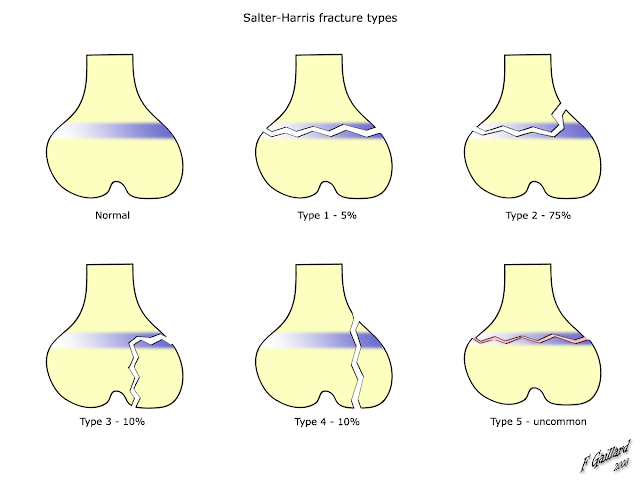 OurMedicalNotes: Salter-Harris Classification