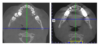 Facial Development Newsletter: AN ALTERNATIVE TREATMENT TO LEFORTE ...