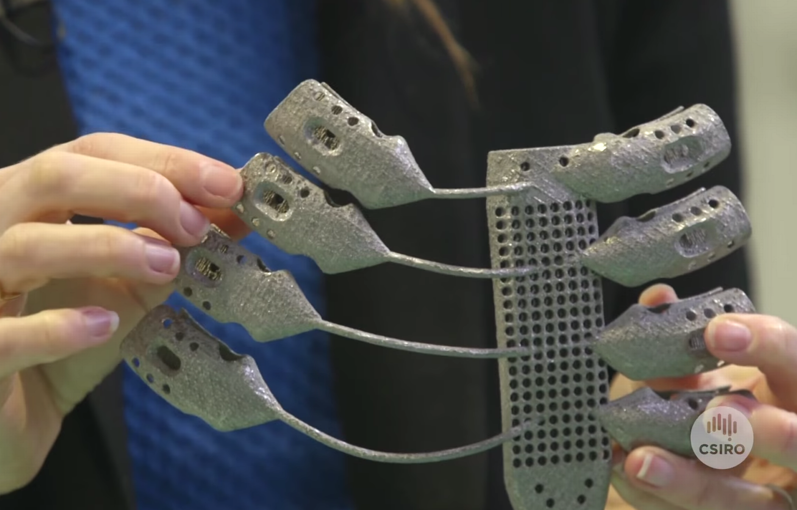 Cancer patient receives world's first 3D printed rib cage in new ...