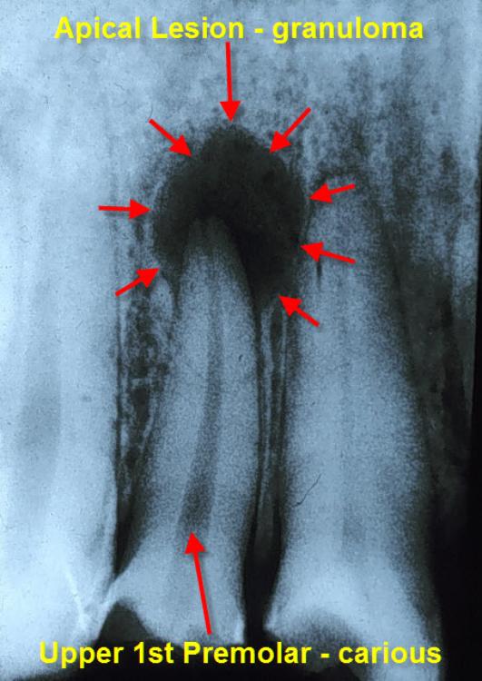 Dentistry and Medicine: Periapical periodontitis