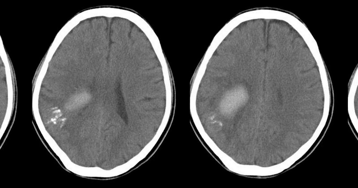 Dr Balaji Anvekar FRCR: Secondary Intracerebral Hemorrhage