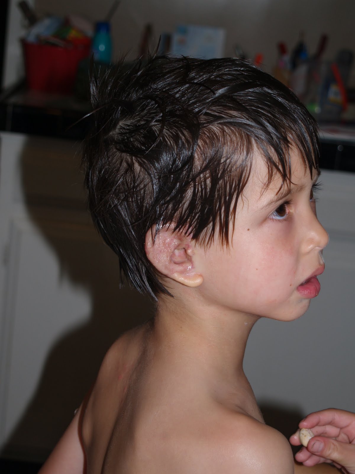 Microtia and Aural Atresia - Our Experience: Five Weeks Post Microtia ...
