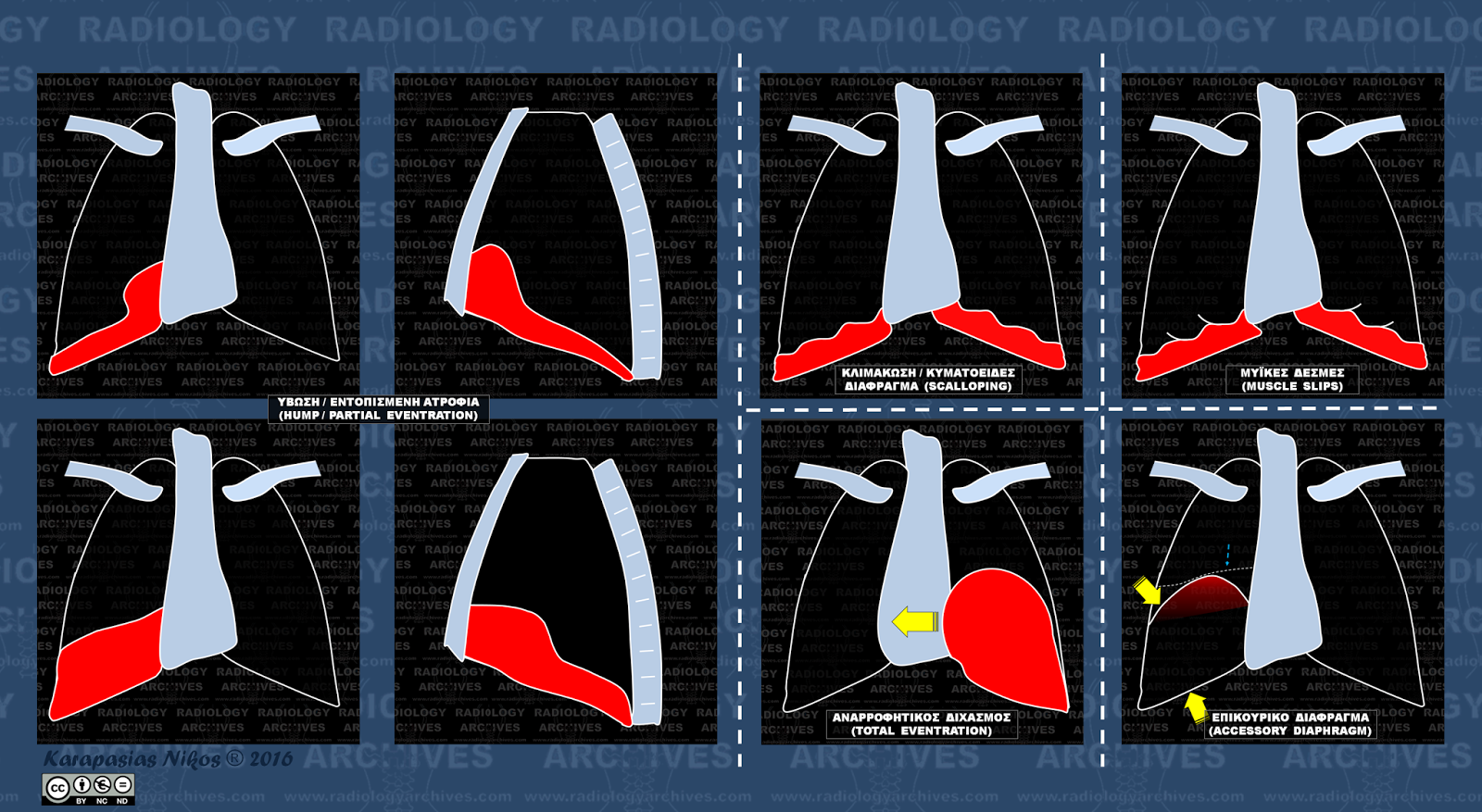 Radiology Archives: Ύβωση Ημιδιαφράγματος (Eventration of Diaphragm)