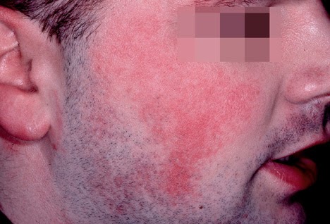 Scarlet Letters, dealing with vascular rosacea, face flushing, burning ...