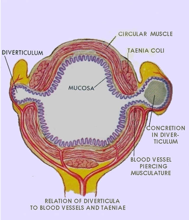 Vasa Recta Diverticulosis