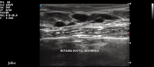 Ectasia Ductal