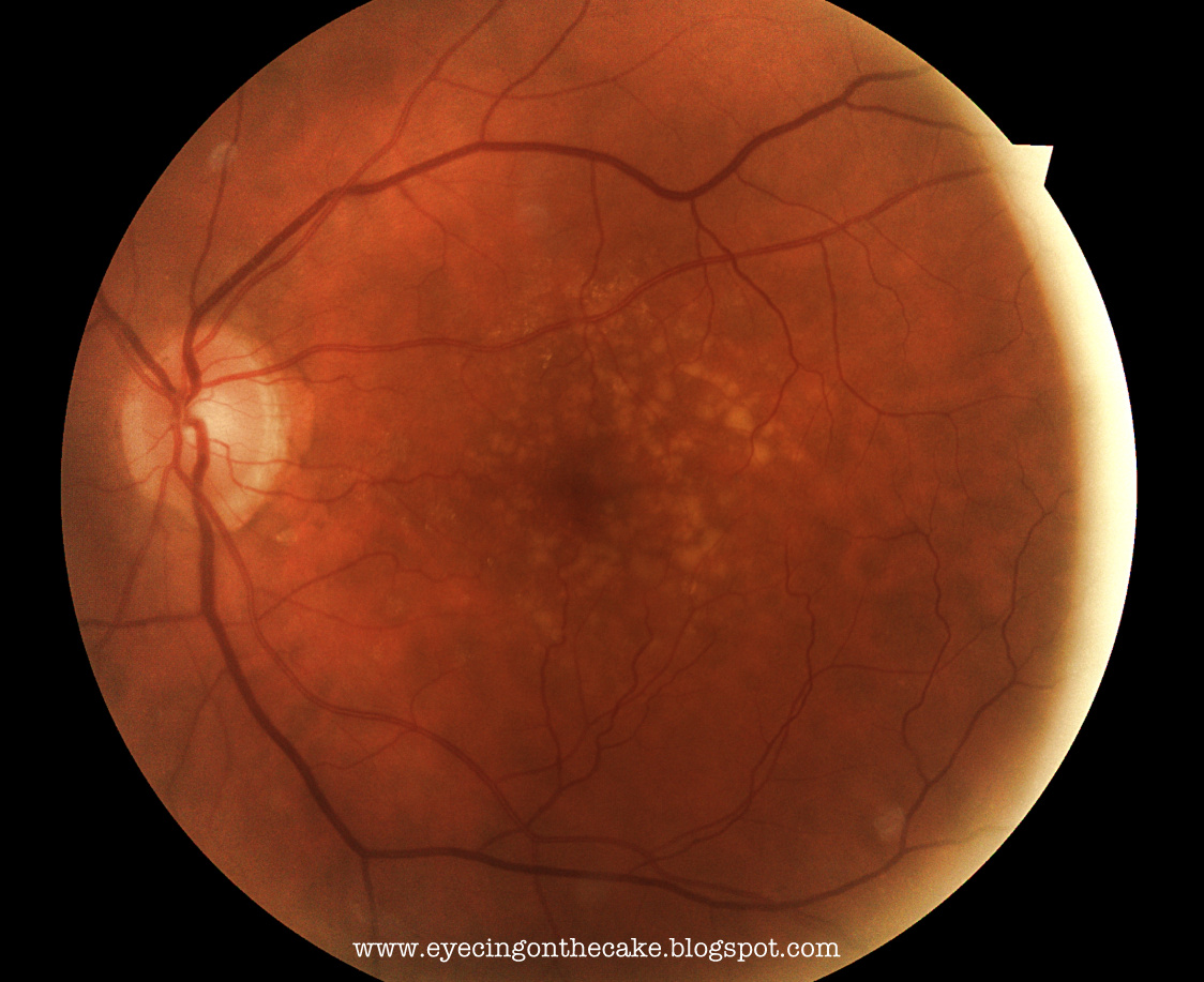 eyecing on the cake: age-related macular degeneration