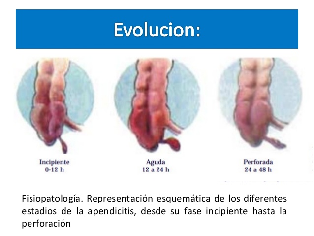 Prevención de Enfermedades: Apendicitis