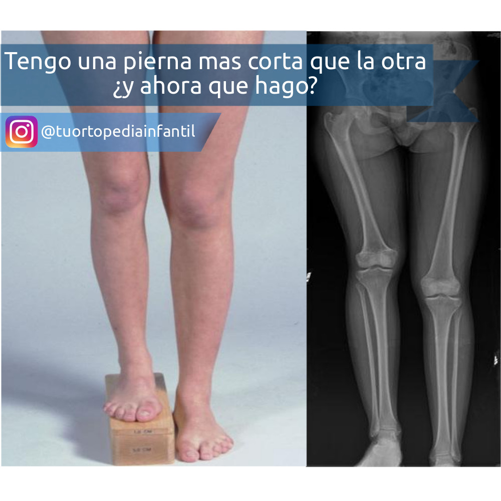 Tengo una pierna mas larga que la otra ¿Ahora que hago? Tengo una pierna mas larga que la otra ¿Ahora que hago?