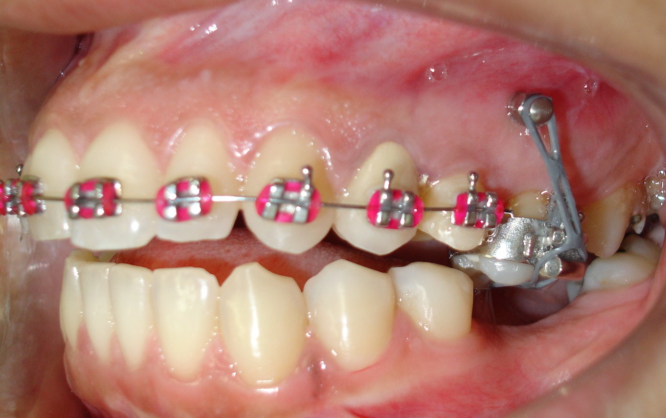 Ortodontia em adultos: CIRURGIA ORTOGNÁTICA E MINI IMPLANTES