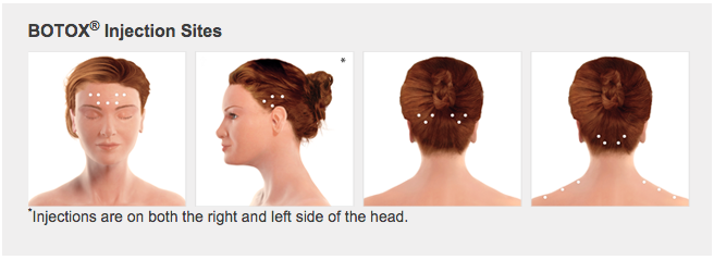 Migraine Mom: Botox For Chronic Migraine: What The Doctor Failed To Mention