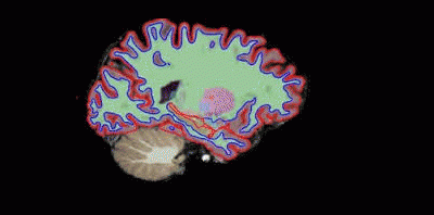 Accidentes Cerebrovasculares: junio 2016
