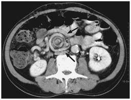 My Radiology World: Volvulus