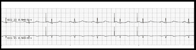 Practice EKG Strips