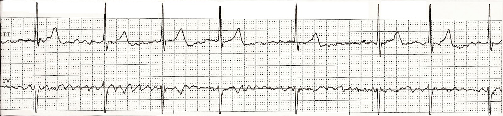 EKG Rhythm Strip Quiz 49