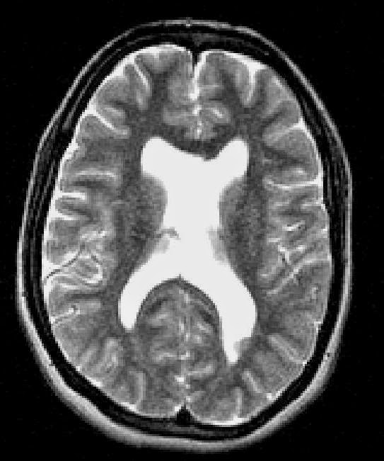 Heterotopia-MRI - Sumer's Radiology Blog