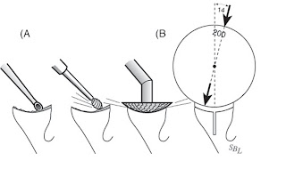 Shoulder Arthritis / Rotator Cuff Tears / Shoulder Pain : Total ...