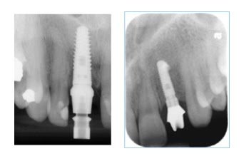 News Room - ROE Dental Laboratory: Capture X-ray to Verify Implant Seating