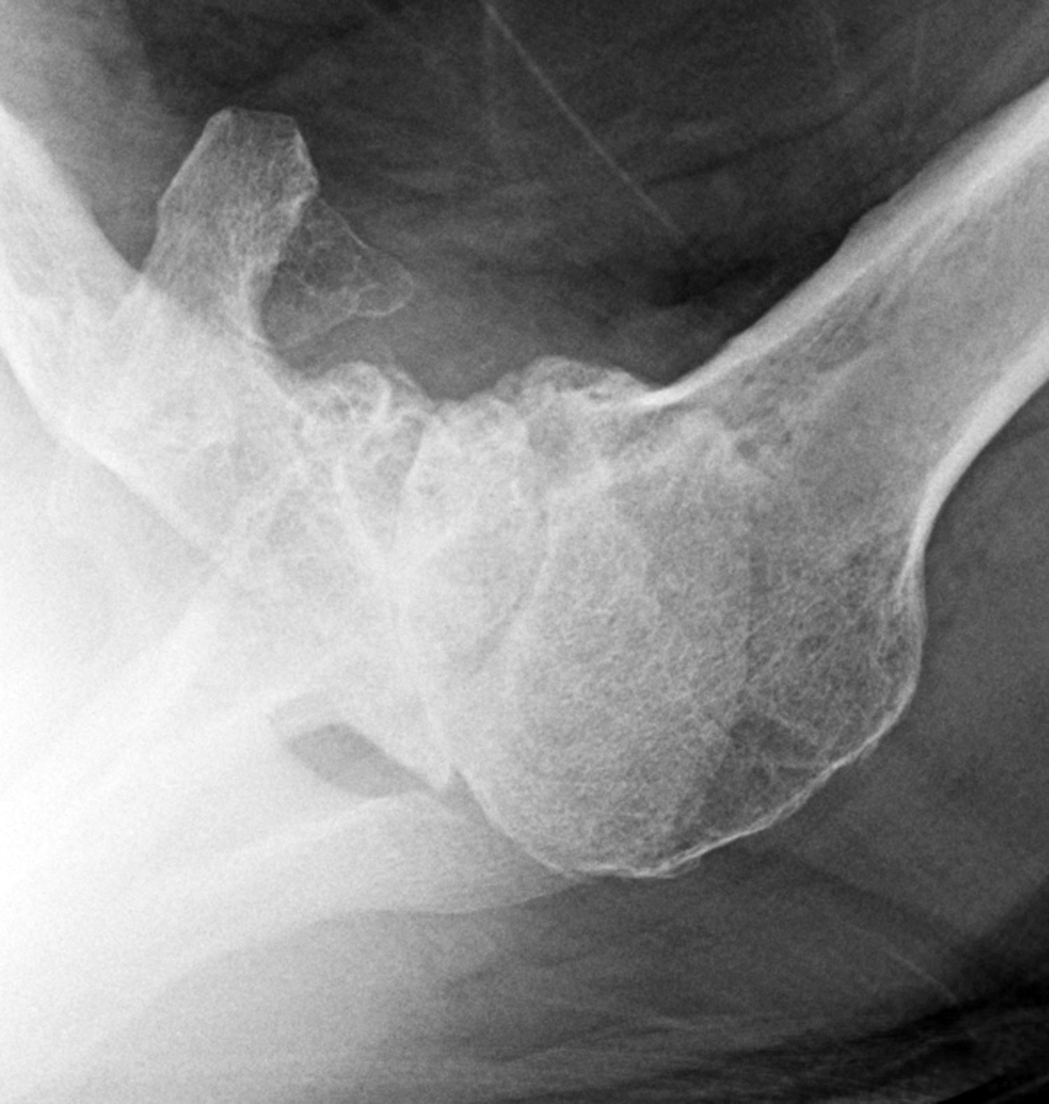 UW Shoulder and Elbow Academy: How bad is the shoulder arthritis on x-ray?