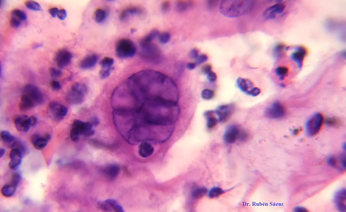 THE PERUVIAN CYTOPATHOLOGY CORNER: CITOLOGÍA CERVICAL: CAMBIOS POR HSV