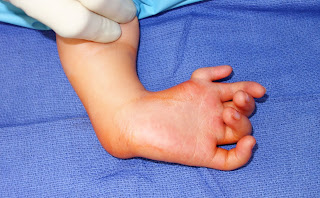 Severe Radial Deficiency- No slowing this kid down! | Congenital Hand ...