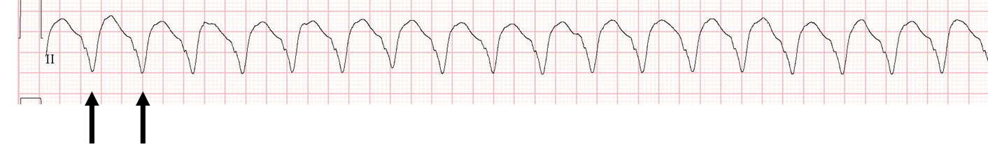 Monomorphic Ventricular Tachycardia