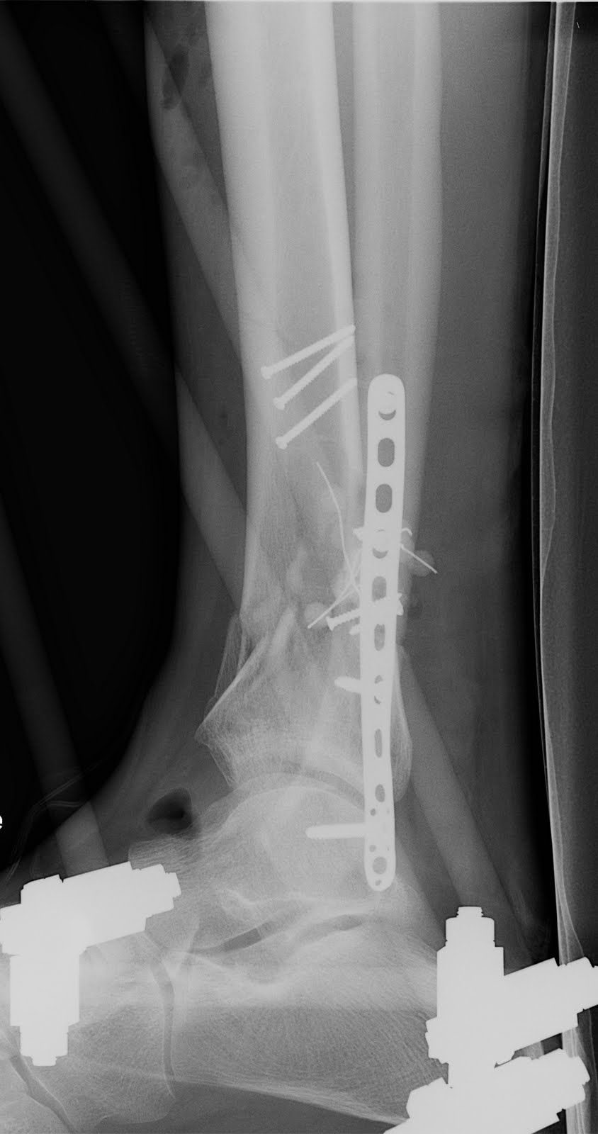 Case of the Month: Fracture cases at Harborview Medical Center ...