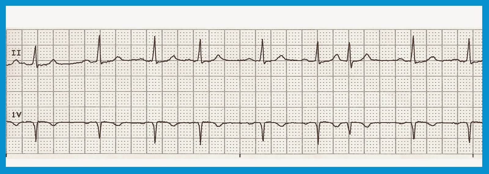 Practice Rhythm Strips 242