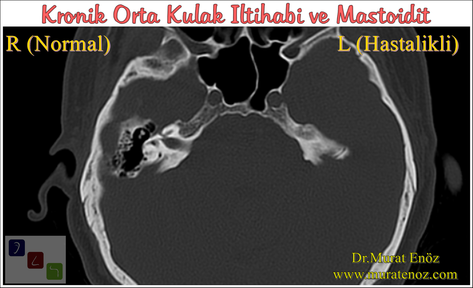 Kronik Orta Kulak İltihabı ve Mastoidit