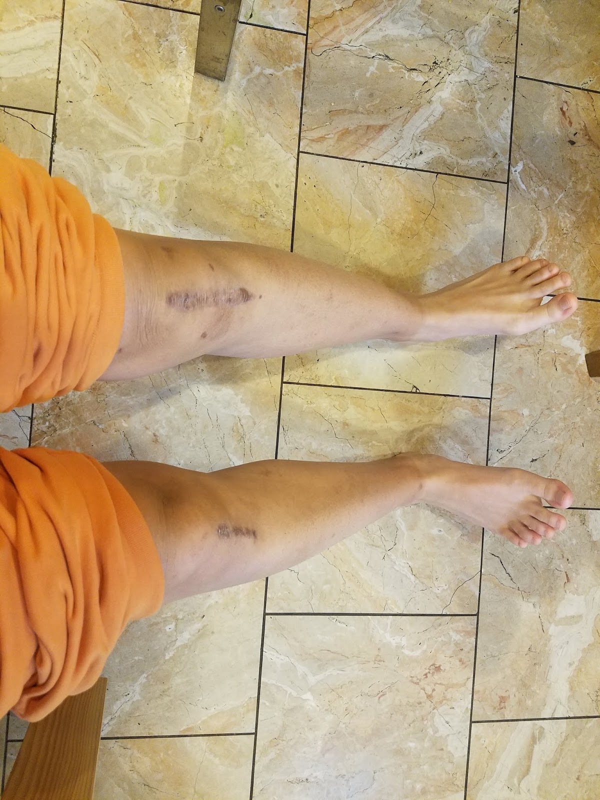 leg reconstruction - AvaMakesThings