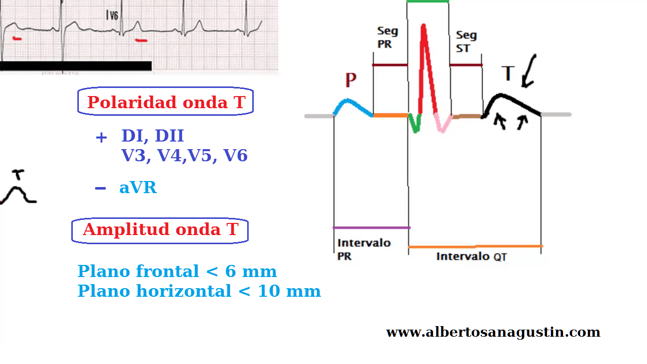 ECG normal (17): Onda T (repolarización ventricular) | Dr. Alberto ... ECG normal (17): Onda T (repolarización ventricular) | Dr. Alberto ...