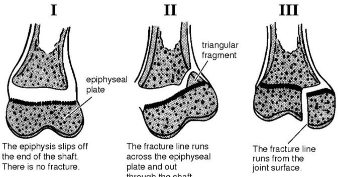 MedicoNotebook: Epiphyseal injuries