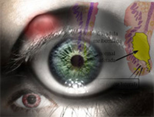 Oftalmologia e Doenças Oculares: Calázio - Quais os sintomas?