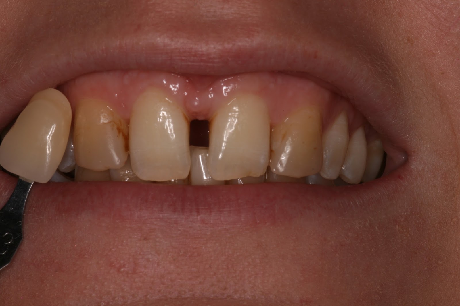 Absolute Dental Centre: Imperfect teeth – "One of the biggest turn offs’"