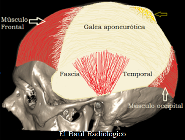 El Baúl Radiológico: LIPOMA SUBGALEAL FRONTAL (Subgaleal Lipoma: CT and ...
